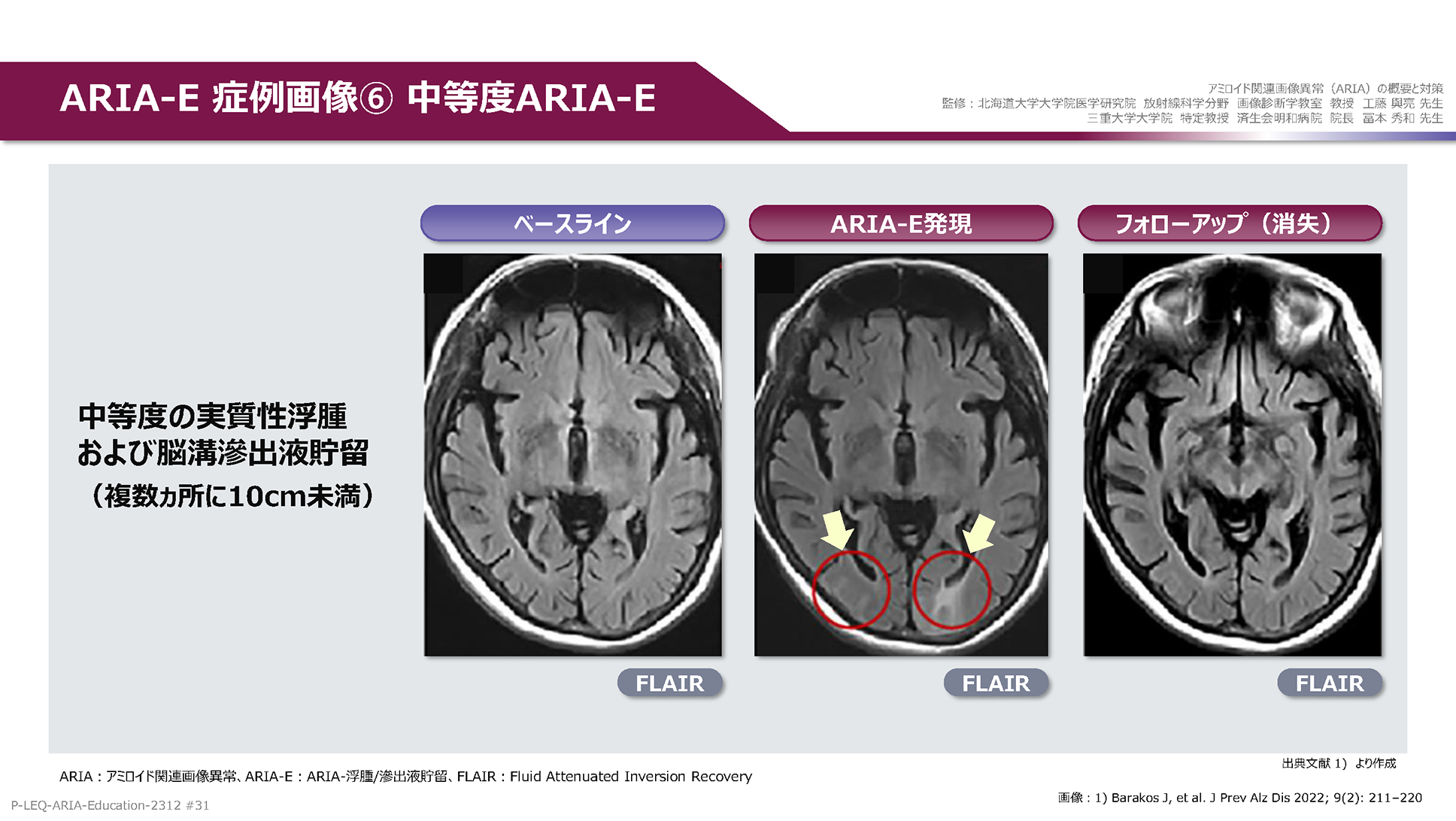ARIA e-learning | レケンビ | エーザイ Medical.eisai.jp 医療関係者向けサイト