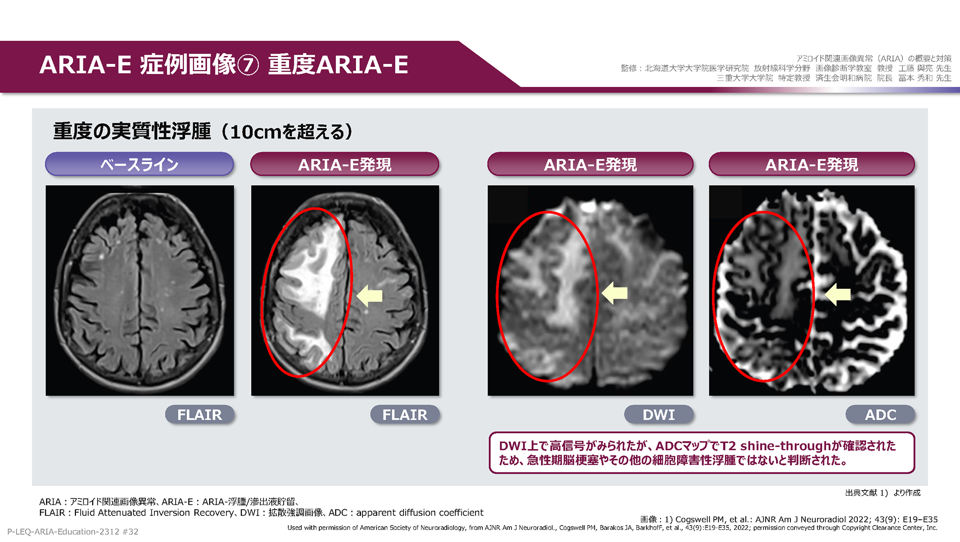 ARIA e-learning | レケンビ | エーザイ Medical.eisai.jp 医療関係者向けサイト