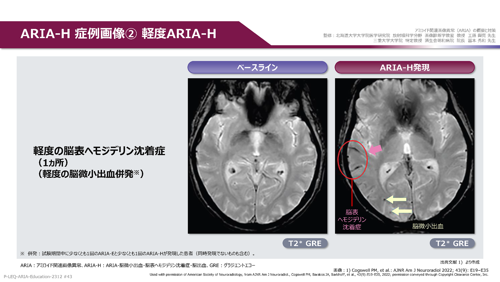 ARIA e-learning | レケンビ | エーザイ Medical.eisai.jp 医療関係者向けサイト